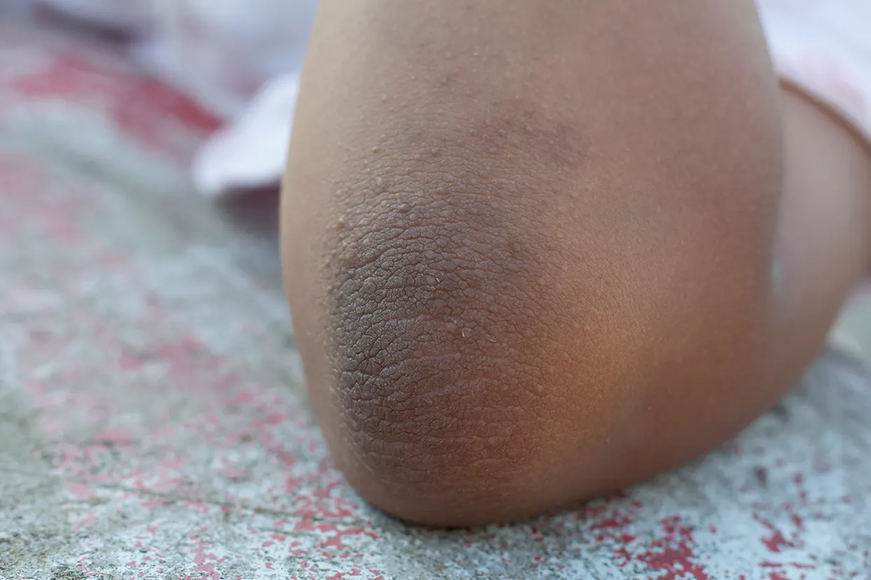 Rash - Northwest Dermatolgoy Group in Oakland County